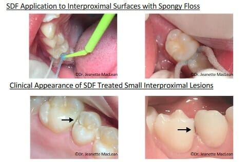 Silver Diamine Fluoride - Hilliard Pediatric Dentistry